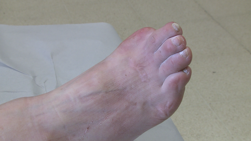 Jiżdiedu n-nies li jitilfu s-swaba' bid-dijabete - TVMnews.mt