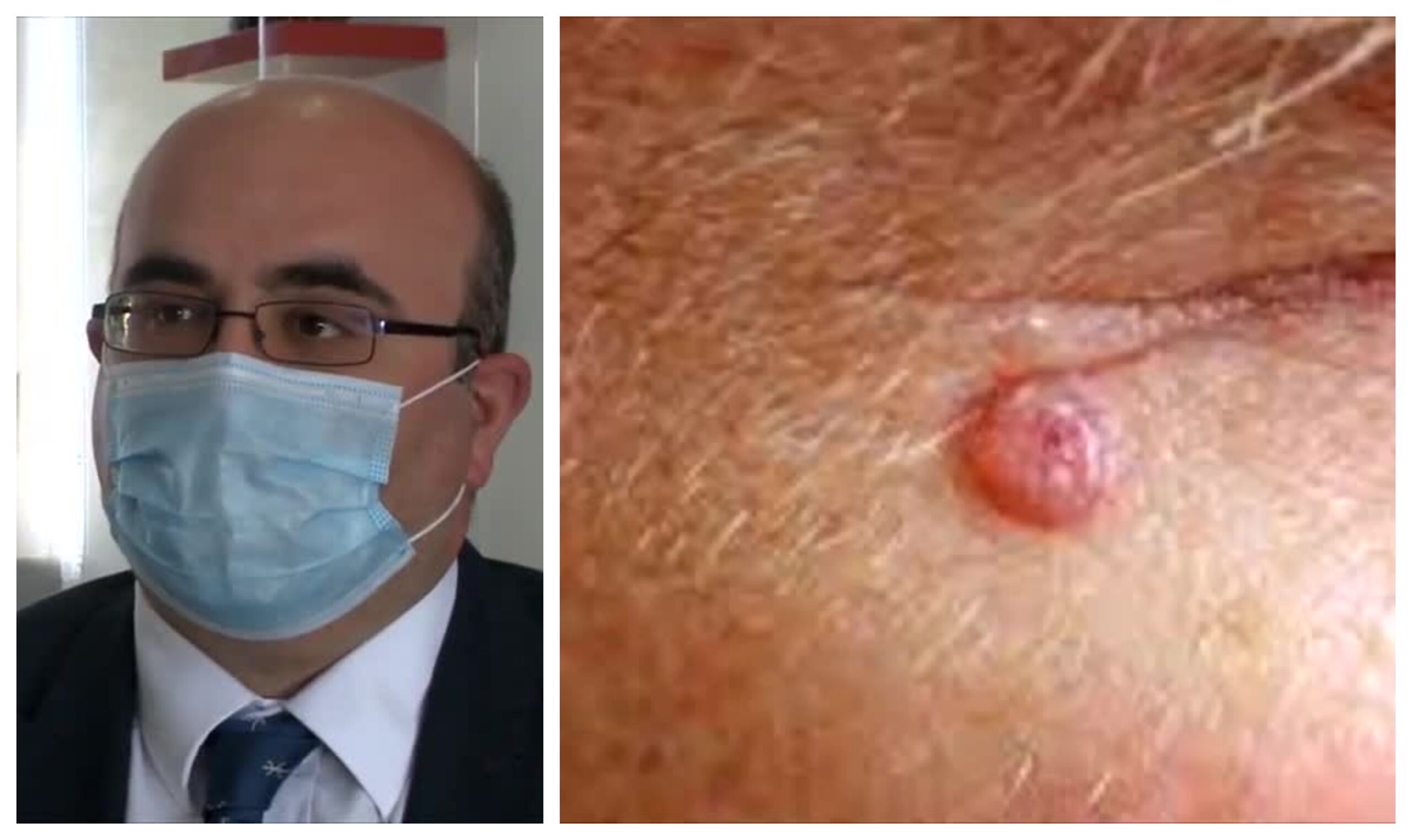 Kirurgu Malti f'tim li sab kura ġdida għall-kanċer tal-ġilda - TVMnews.mt