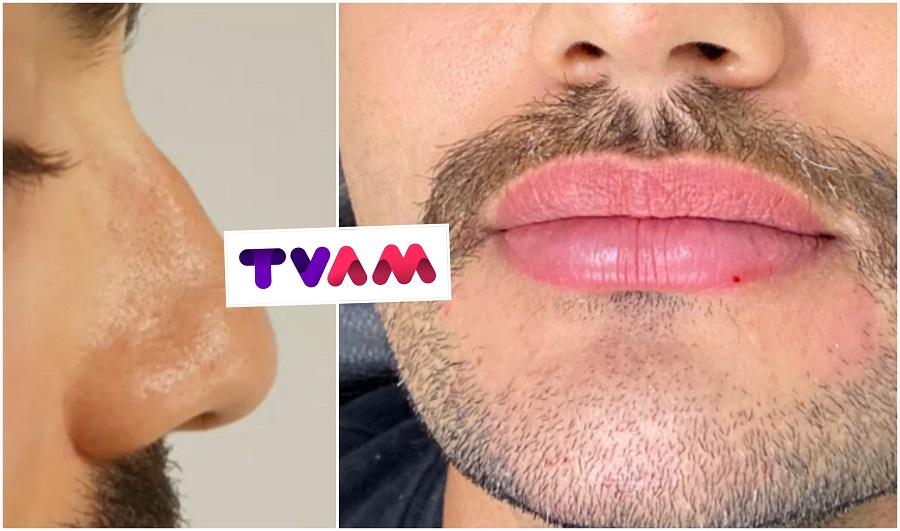 Watch: "More Maltese men getting botox treatment" - TVMnews.mt