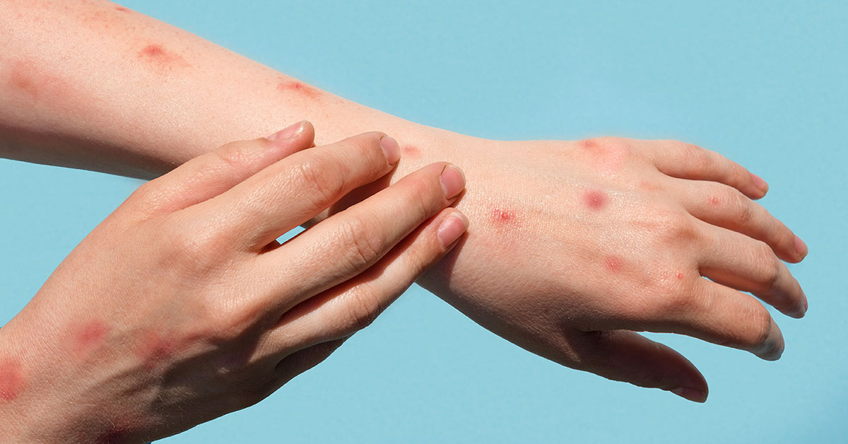 Second case of Mpox confirmed in Malta - first patient has Clade II ...